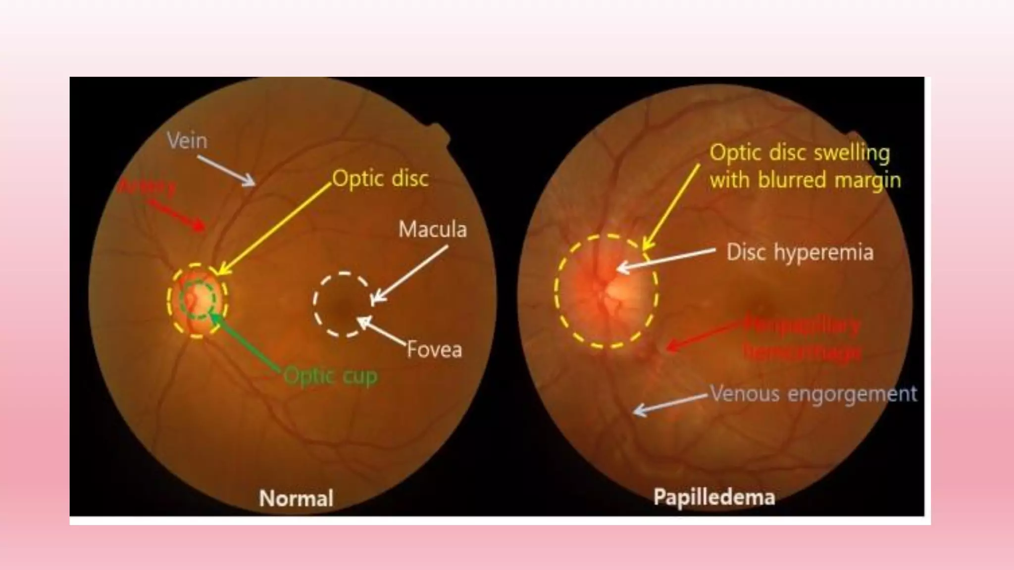 Papilloedema | PDF