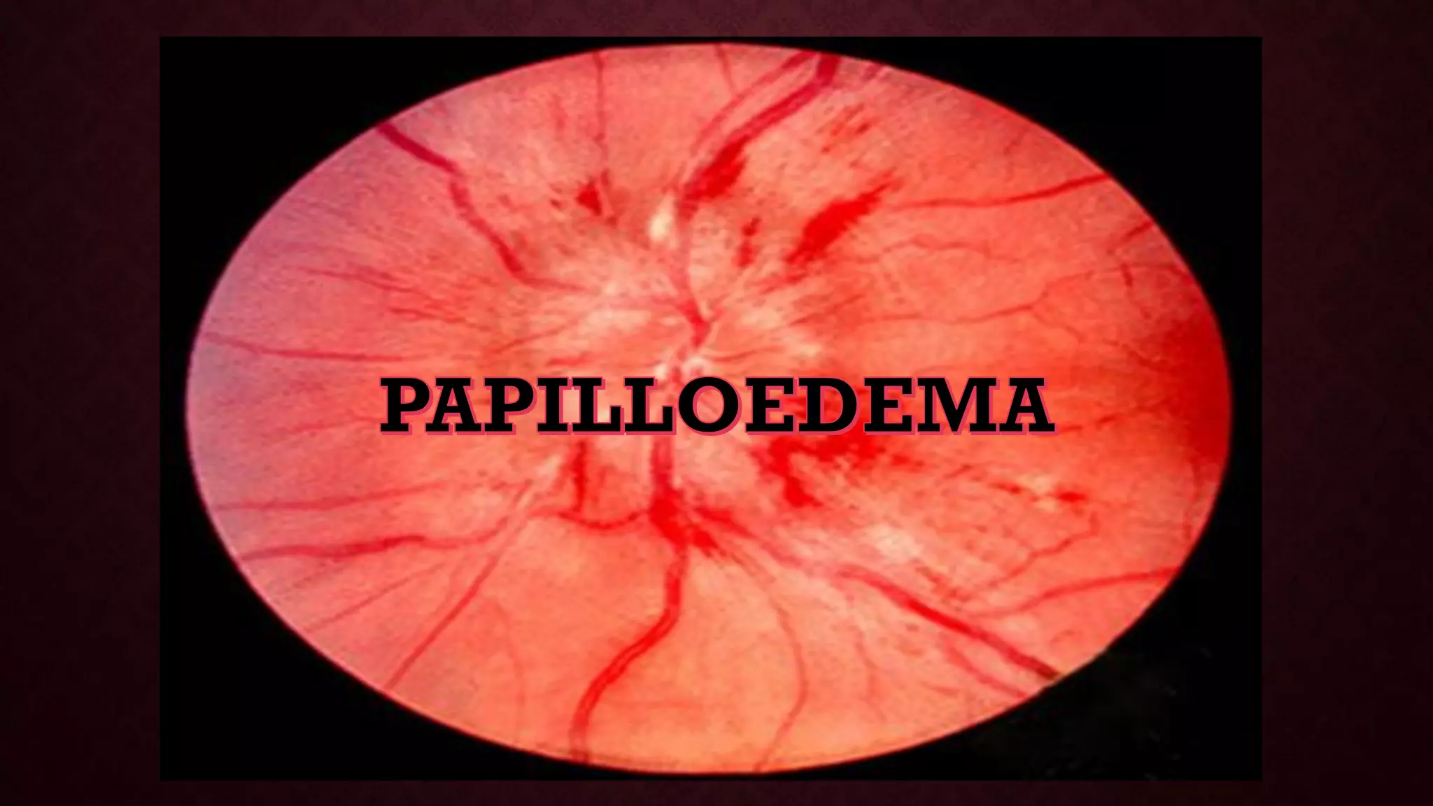 Papilloedema | PDF