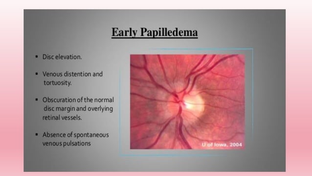 Papilloedema | PDF