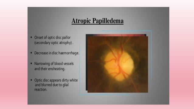Papilloedema | PDF