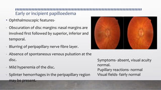 Papilloedema | PPTX