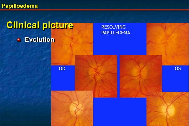 Papilloedema.PPT
