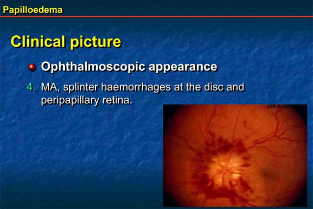 Papilloedema.PPT