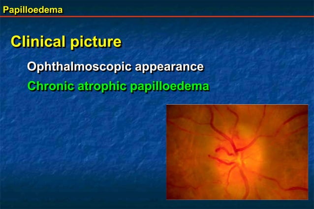 Papilloedema.PPT