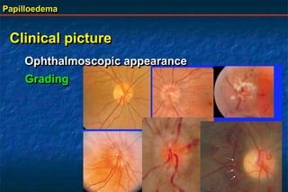 Papilloedema.PPT