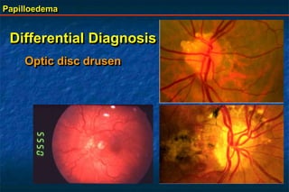 Papilloedema.PPT