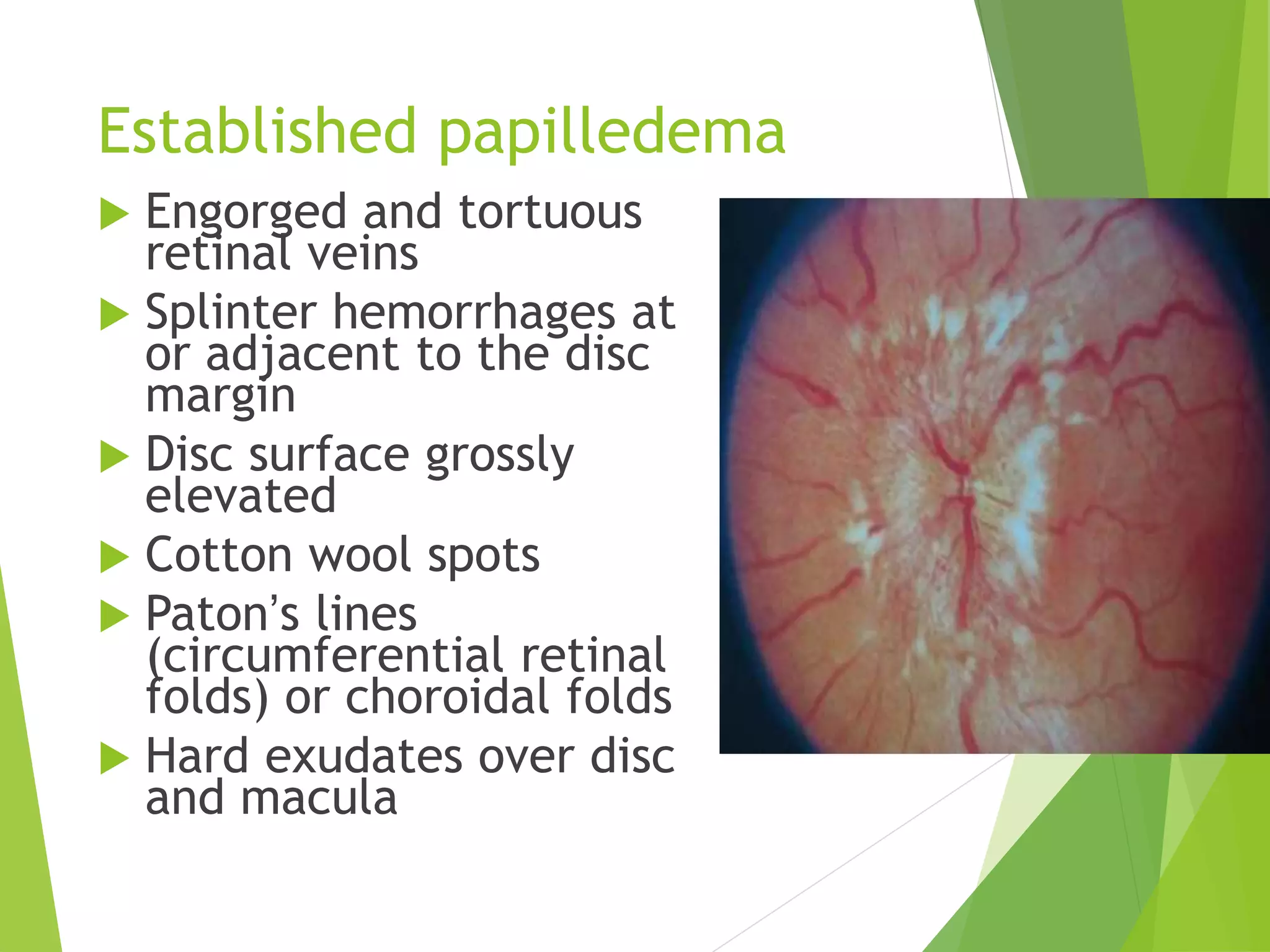 Papilloedema and Optic Atrophy.ppt