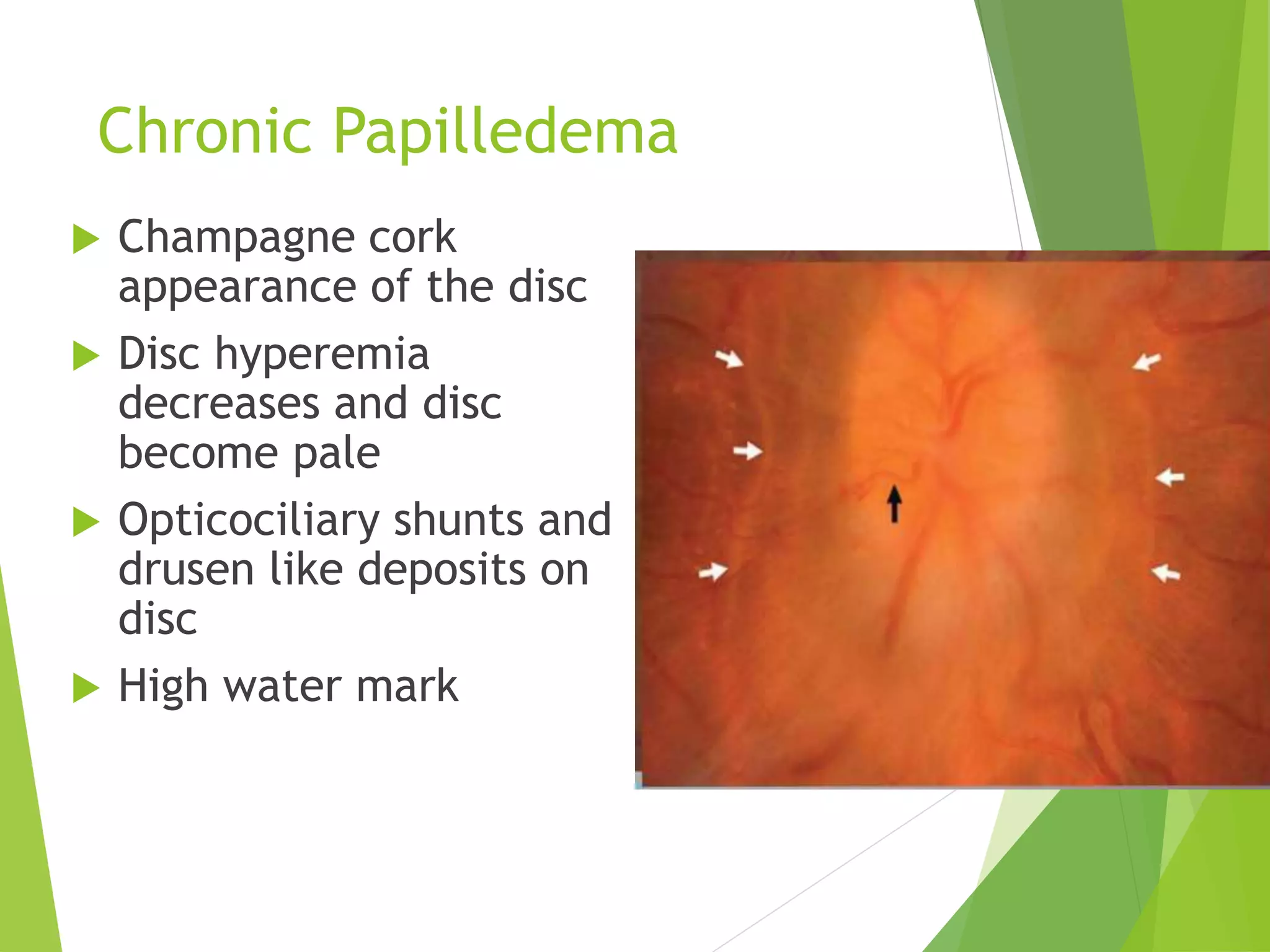 Papilloedema and Optic Atrophy.ppt