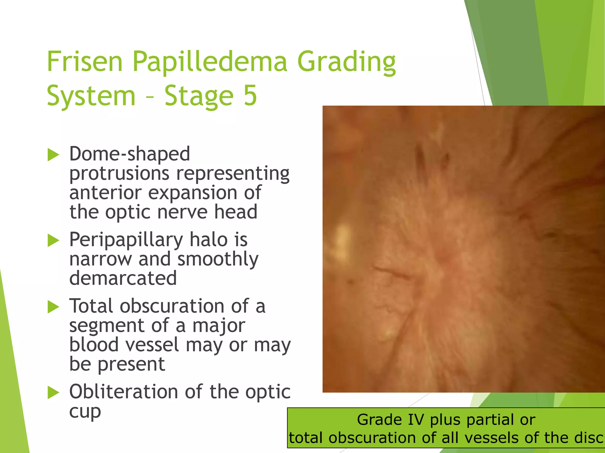 Papilloedema and Optic Atrophy.ppt