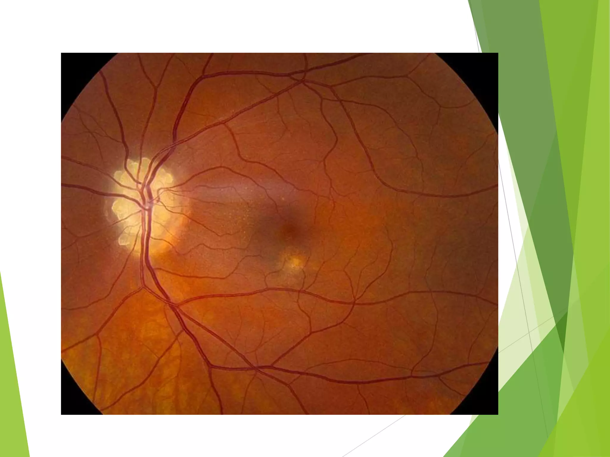 Papilloedema and Optic Atrophy.ppt