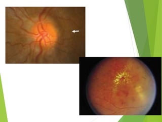 Papilloedema and Optic Atrophy.ppt