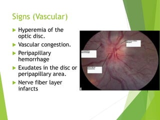 Papilloedema and Optic Atrophy.ppt