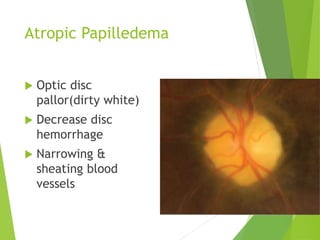Papilloedema and Optic Atrophy.ppt