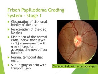 Papilloedema and Optic Atrophy.ppt