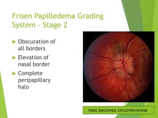 Papilloedema and Optic Atrophy.ppt