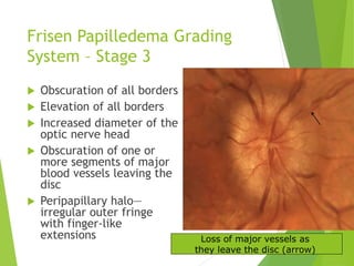 Papilloedema and Optic Atrophy.ppt