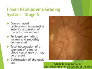 Papilloedema and Optic Atrophy.ppt
