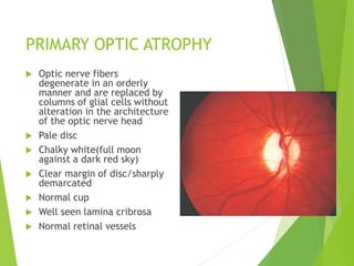 Papilloedema and Optic Atrophy.ppt