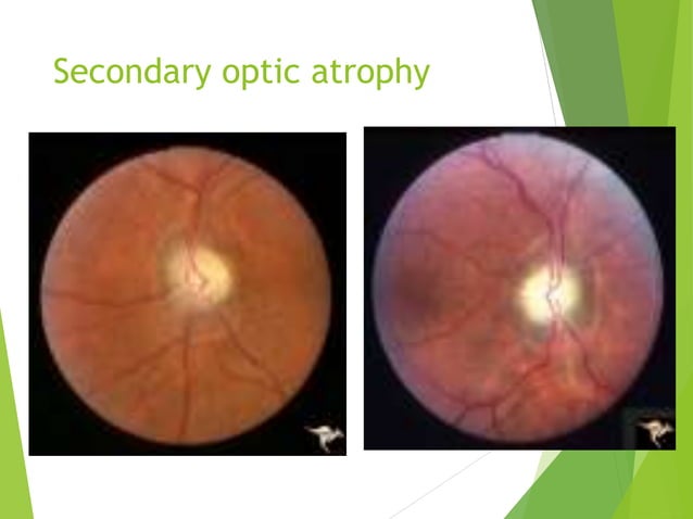 Papilloedema and Optic Atrophy.ppt | Eye and Vision Conditions ...