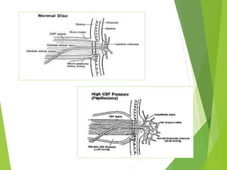 Papilloedema and Optic Atrophy.ppt