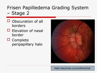 Papilloedema and Optic Atrophy-optha.ppt