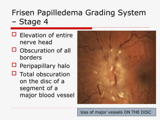 Papilloedema and Optic Atrophy-optha.ppt