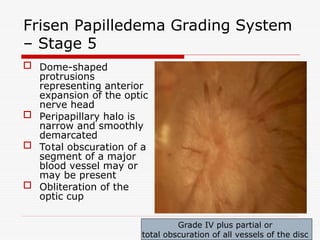 Papilloedema and Optic Atrophy-optha.ppt