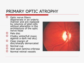 Papilloedema and Optic Atrophy-optha.ppt