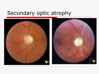 Papilloedema and Optic Atrophy-optha.ppt