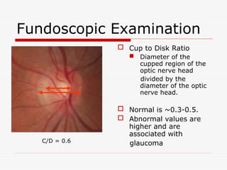 Papilloedema and Optic Atrophy-optha.ppt | Eye and Vision Conditions ...