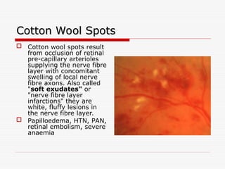 Papilloedema and Optic Atrophy-optha.ppt