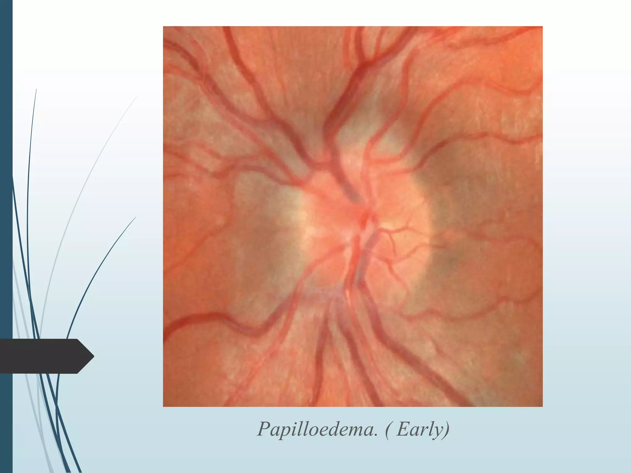Papilloedema presentation1 | PPTX