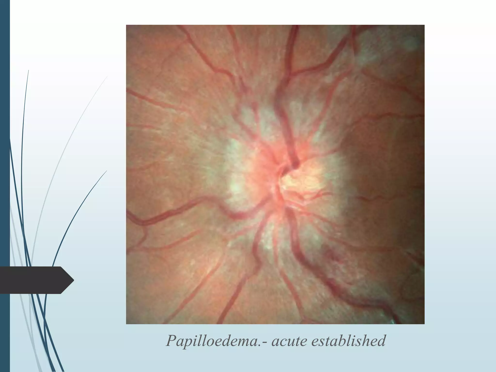 Papilloedema presentation1 | PPTX