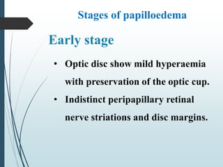 Papilloedema presentation1 | PPTX