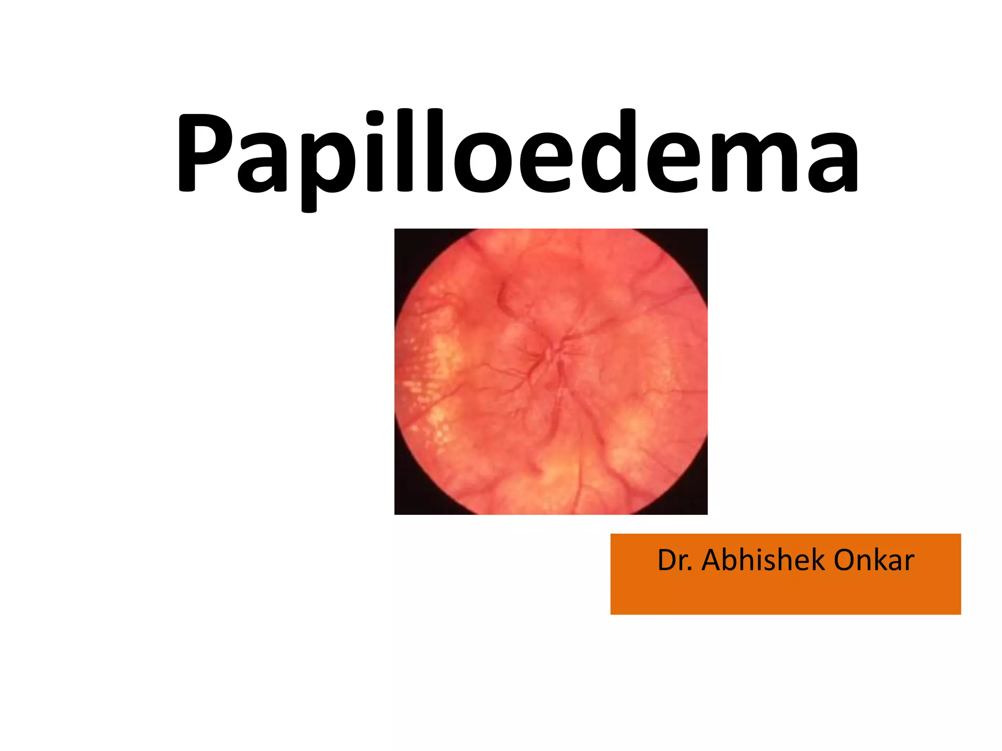 Papilloedema | PPTX | Eye and Vision Conditions | Diseases and Conditions