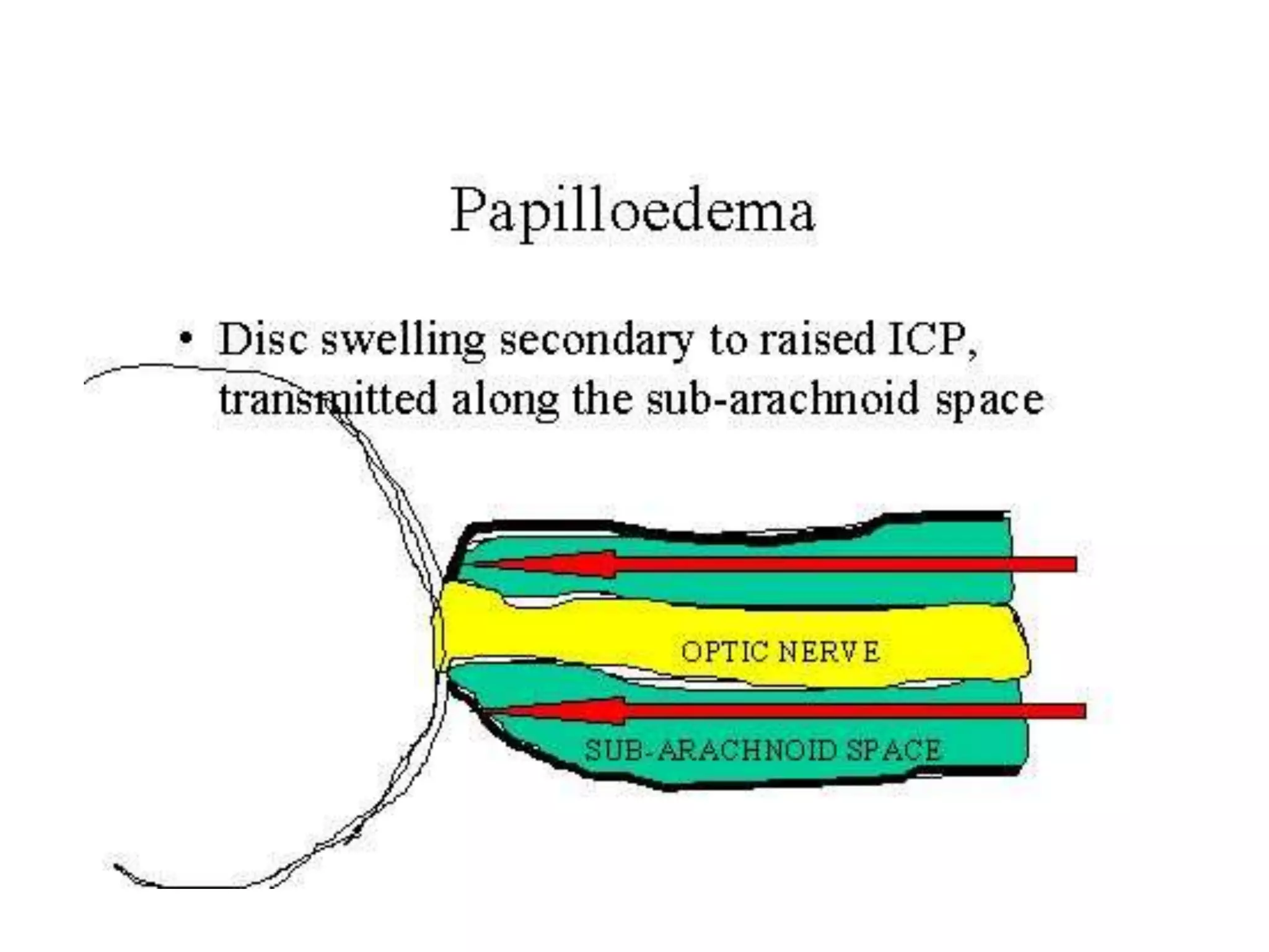 Papilloedema | PPTX | Eye and Vision Conditions | Diseases and Conditions