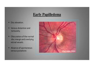 Papilloedema | PPTX | Eye and Vision Conditions | Diseases and Conditions