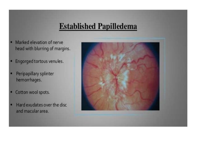 Papilloedema | PPTX | Eye and Vision Conditions | Diseases and Conditions