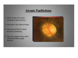 Papilloedema | PPTX | Eye and Vision Conditions | Diseases and Conditions