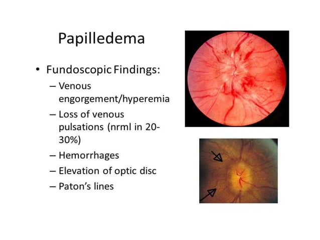Papilloedema | PPTX | Eye and Vision Conditions | Diseases and Conditions