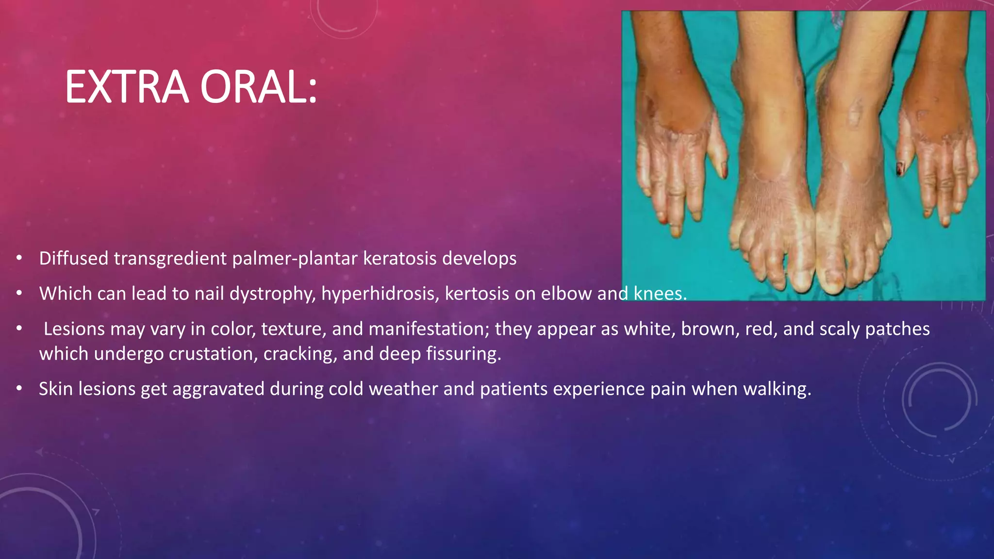 Papillon lefevre syndrome | PPTX