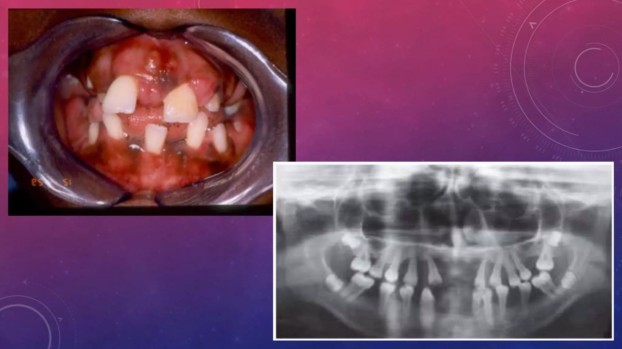 Papillon lefevre syndrome | PPTX