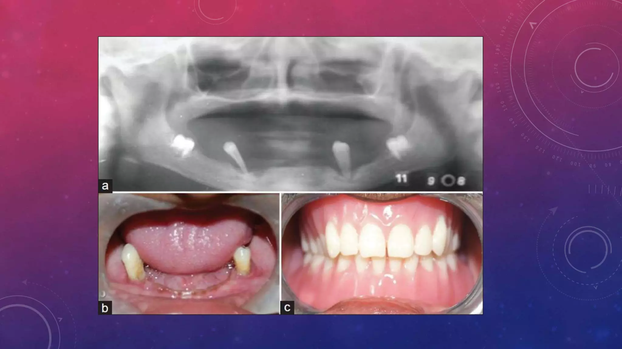 Papillon lefevre syndrome | PPTX