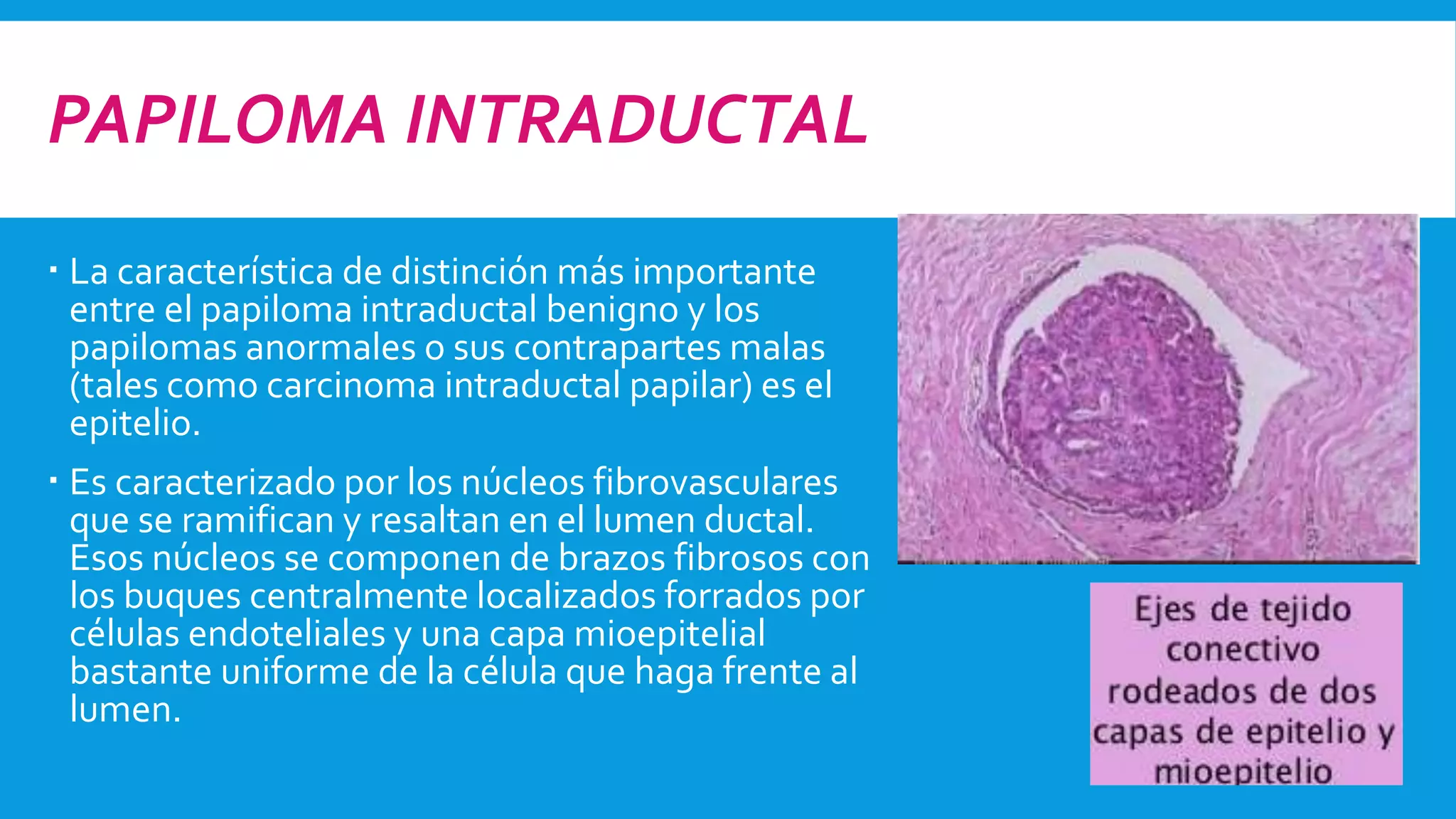Papiloma intraductal | PPTX
