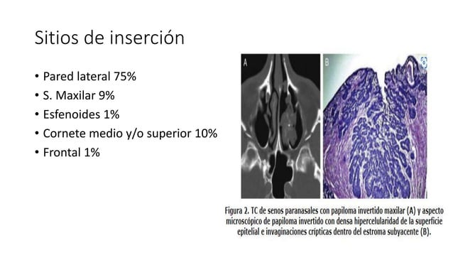 PAPILOMA NASAL INVERTIDO, tumores benignos de nariz y spn.pptx