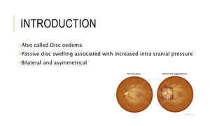 PAPILLOEDEMA | PPTX