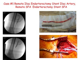 Hybrid procedure | PDF | Heart and Cardiovascular Diseases | Diseases ...