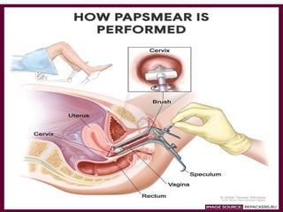 PAP smear.pptx