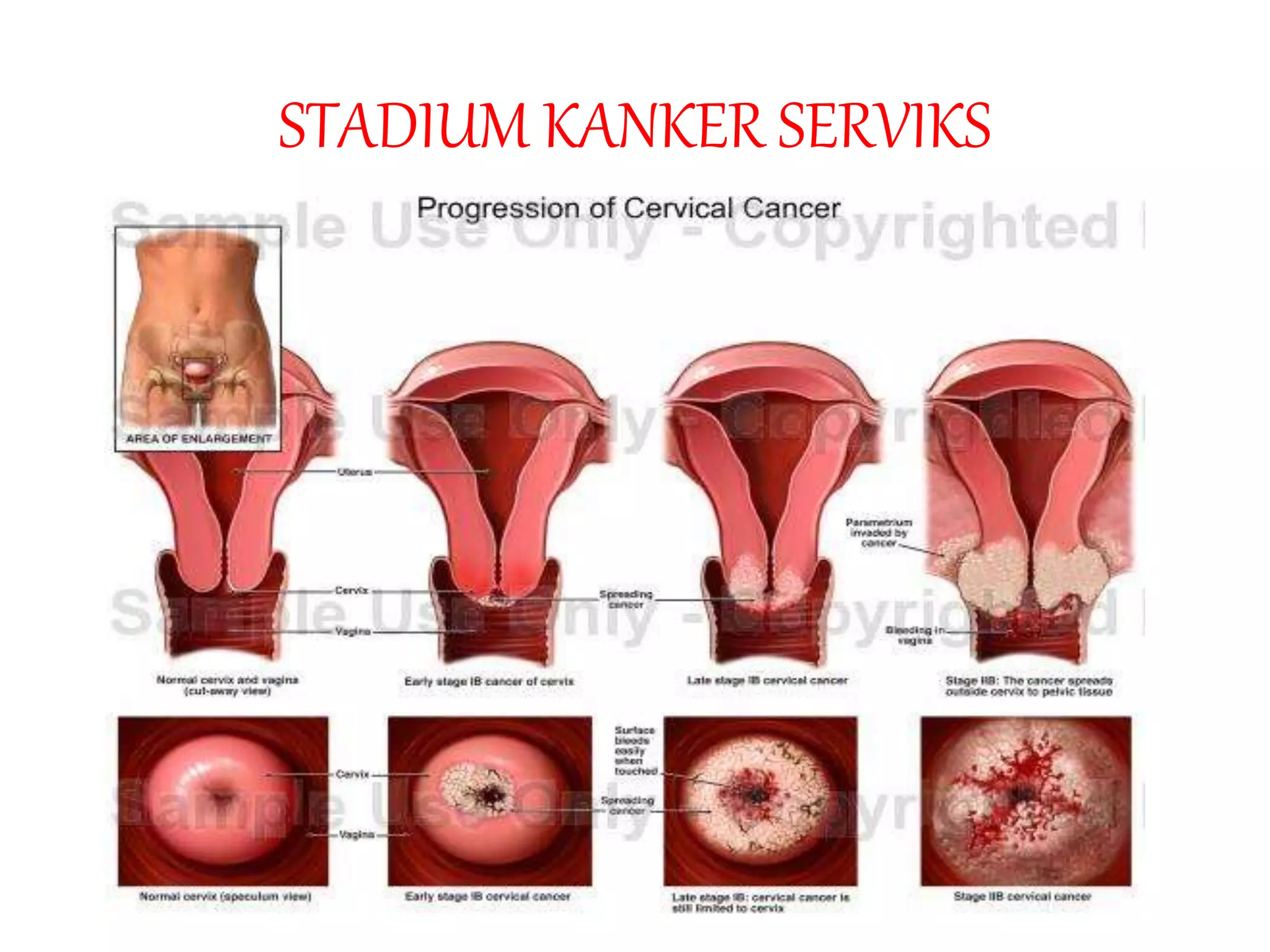 PAP SMEAR vs KANKER LEHER RAHIM.ppt