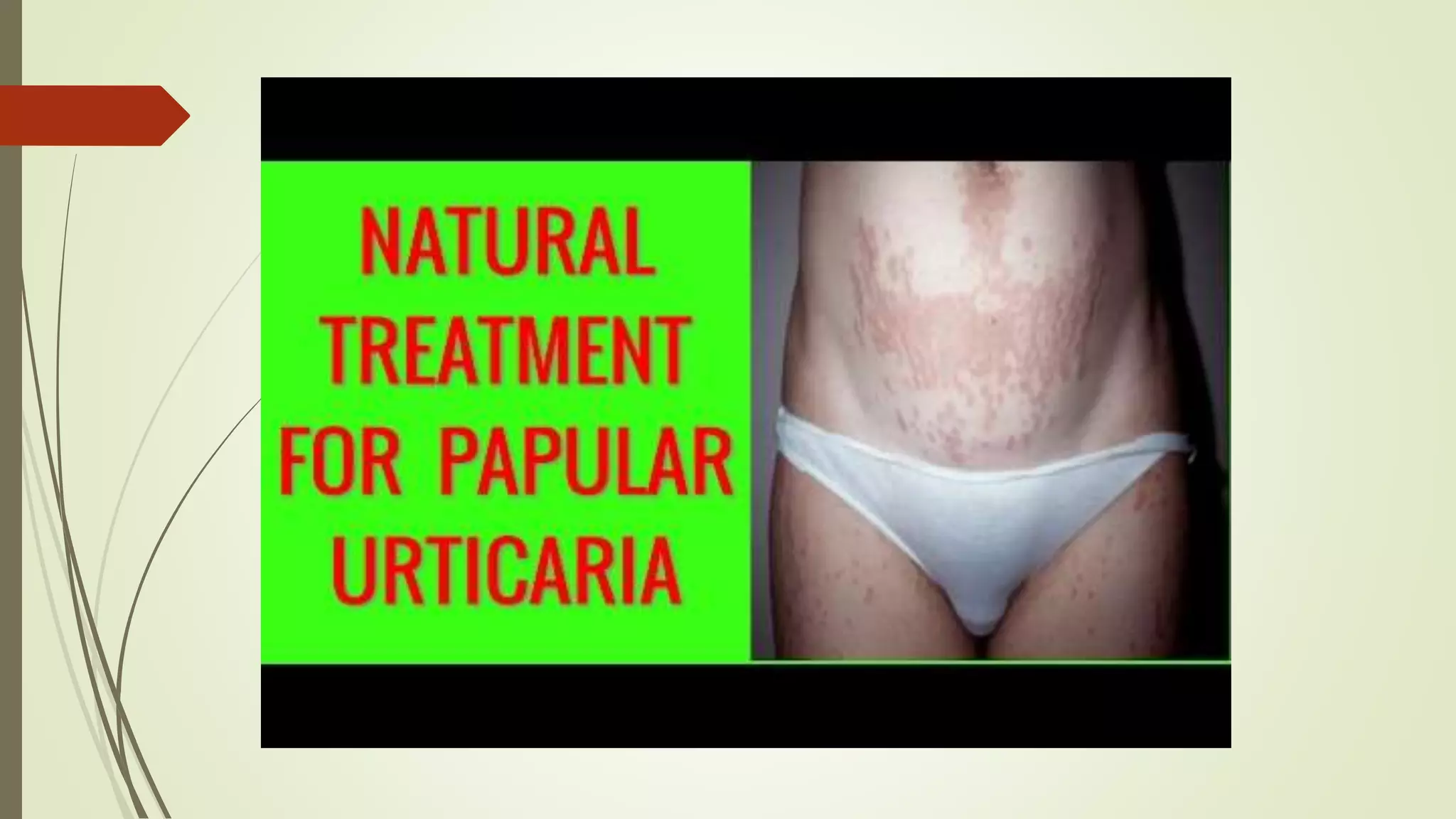 Papular Urticaria Ppt